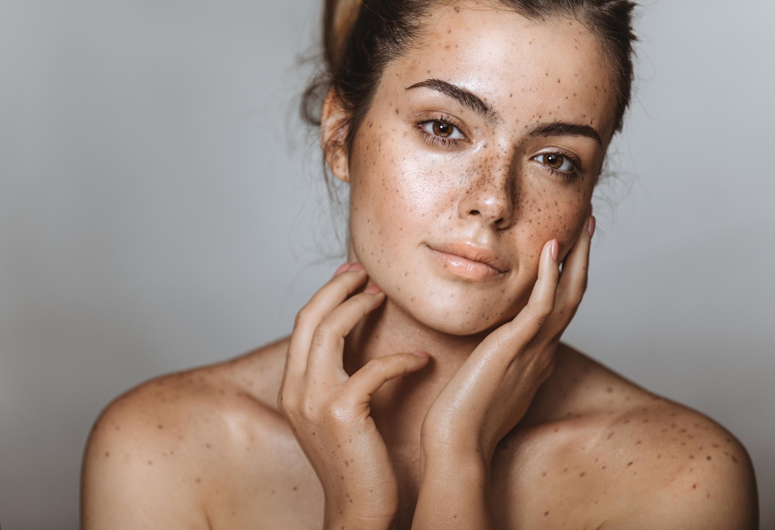 Age Spots - Papillon Skin Clinic