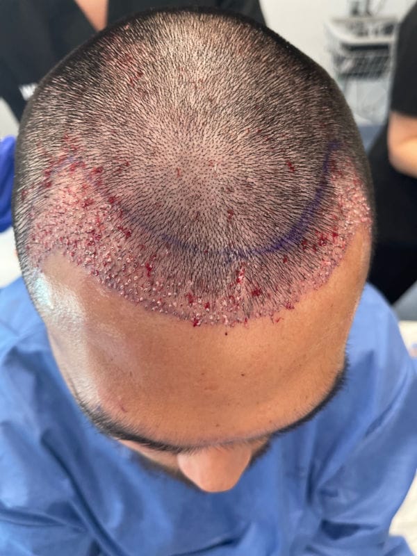 Hair Transplants - Papillon Skin Clinic